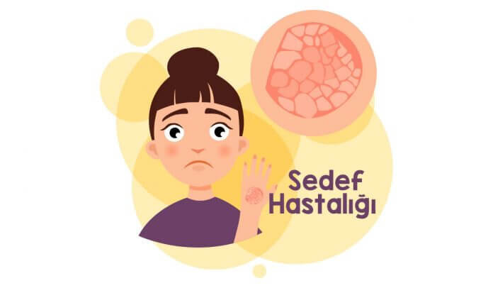 Sedef Hastalığı Nedir, Sedef Hastalığına Ne İyi Gelir? | En İyi Vitamin
